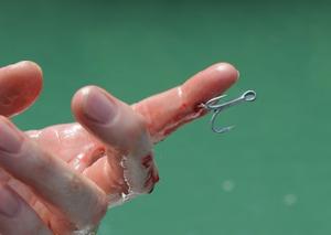 Ouch!! Fish hook injuries - Fishing World