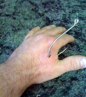 Ouch!! Fish hook injuries - Fishing World